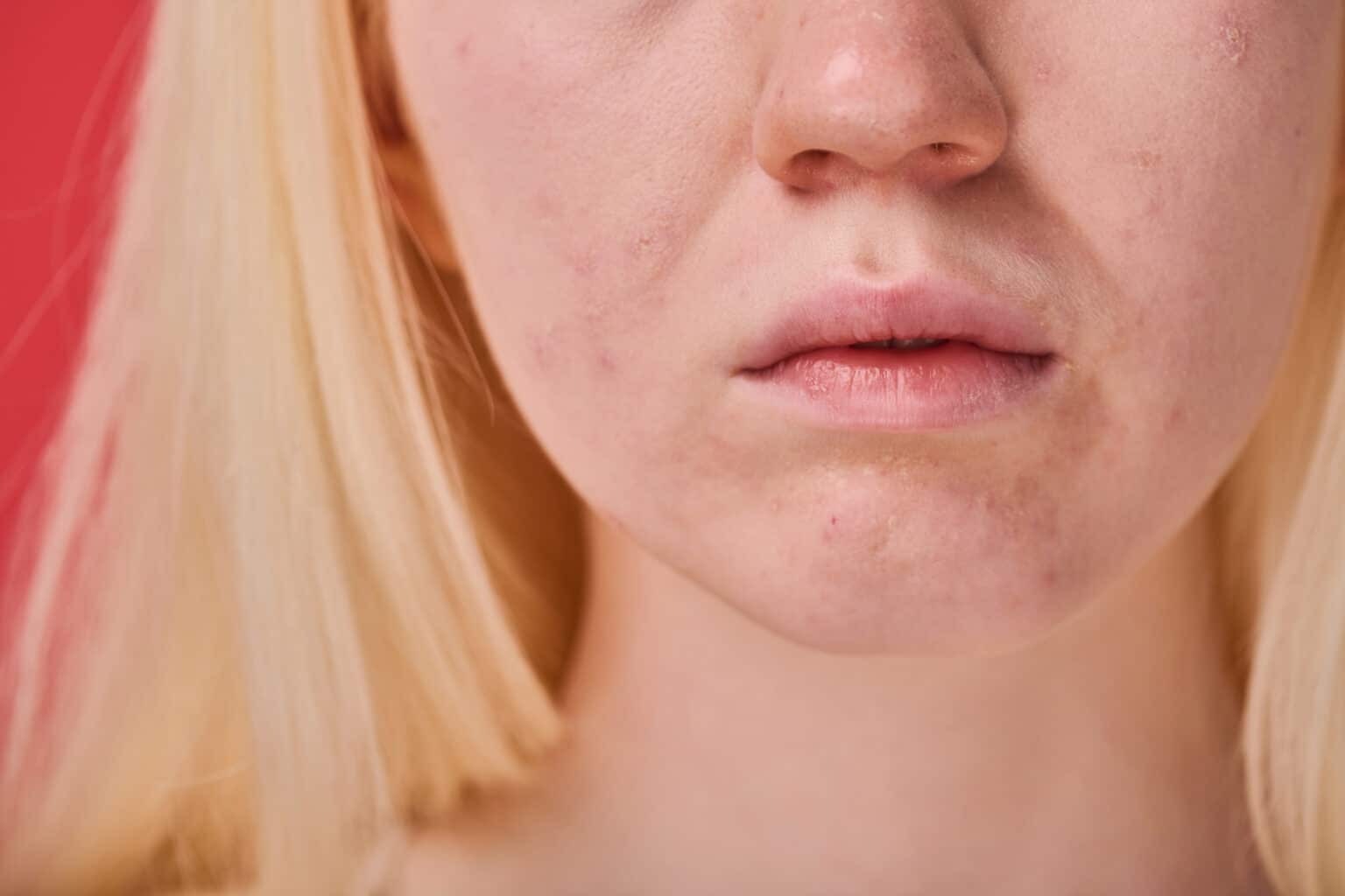 Redness on the face: what beauty routine should you follow?