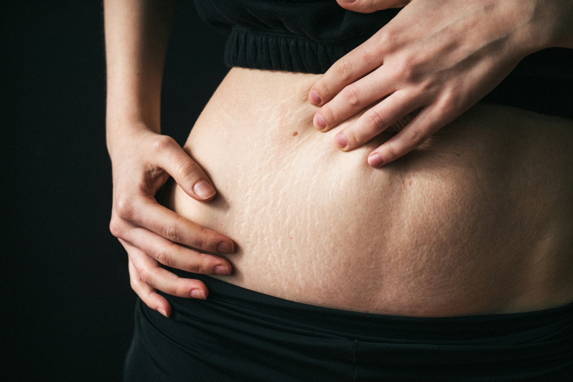 Stretch marks: How to prevent and treat them?
